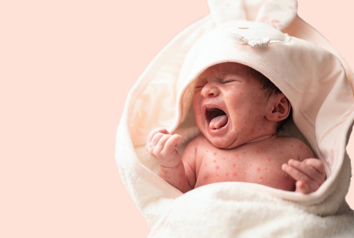 Comment identifier une éruption cutanée due à la rougeole